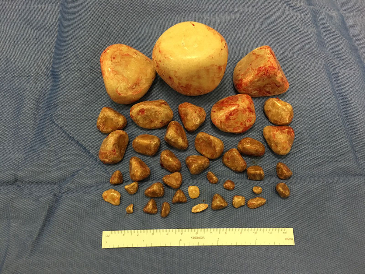 Calcolosi renale e formazione dei calcoli - Litotrissia Roma