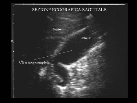 Calcolo Colecisti - Calcolo Ø 10mm della colecisti 2 - Litotrissia Roma
