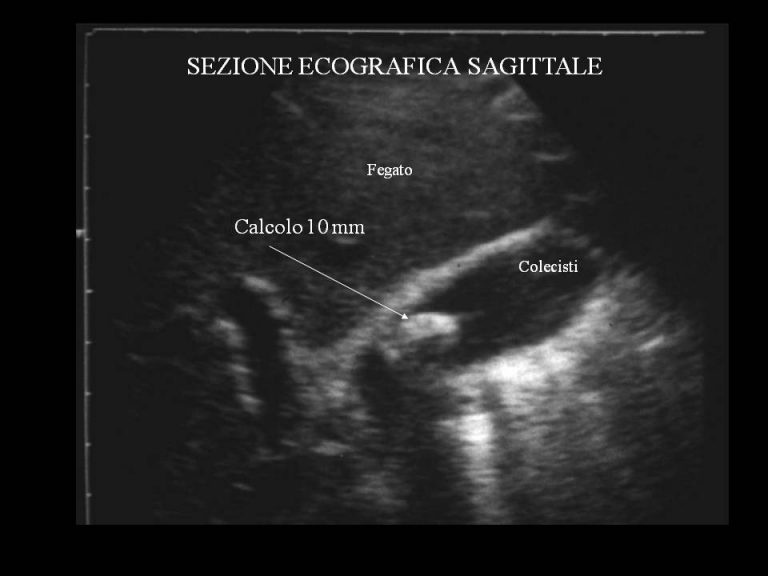 Calcolo Colecisti - Calcolo Ø 10mm della colecisti 2 - Litotrissia Roma