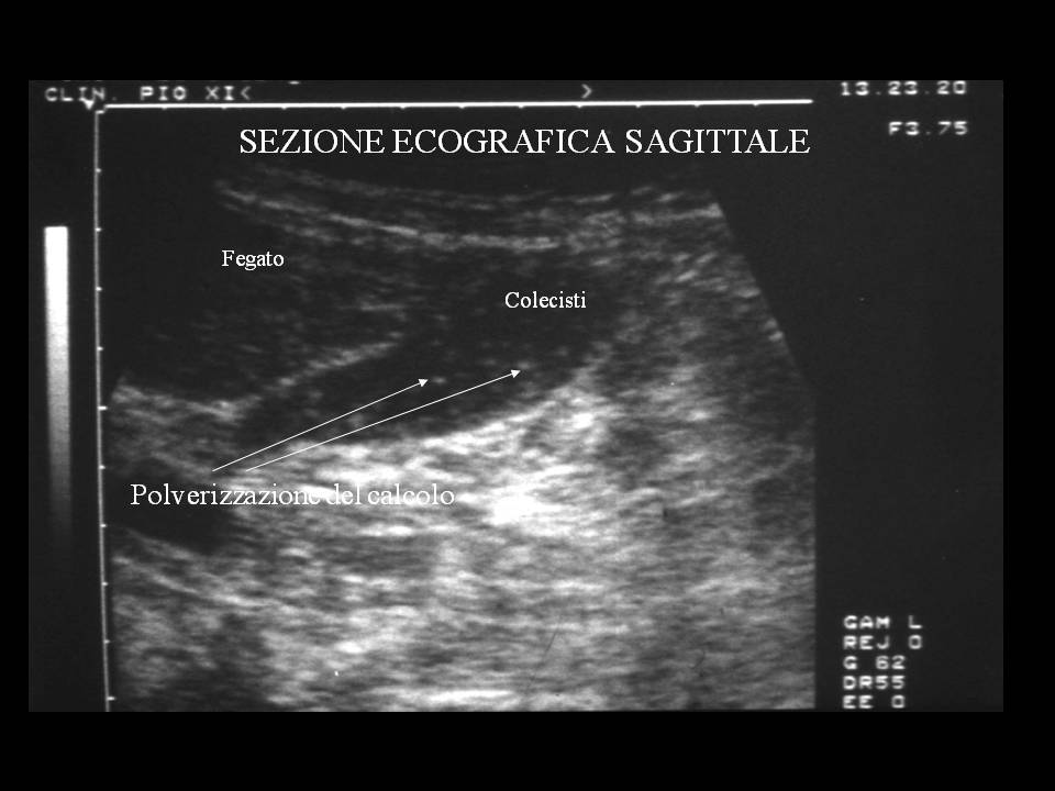Calcolo della colecisti Ø 10mm - Unità Litotrissia Extracorporea Roma