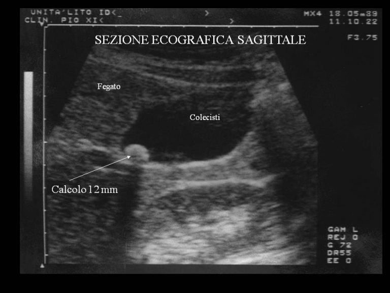 Unità di Litotrissia Extracorporea | Litiasi della colecisti