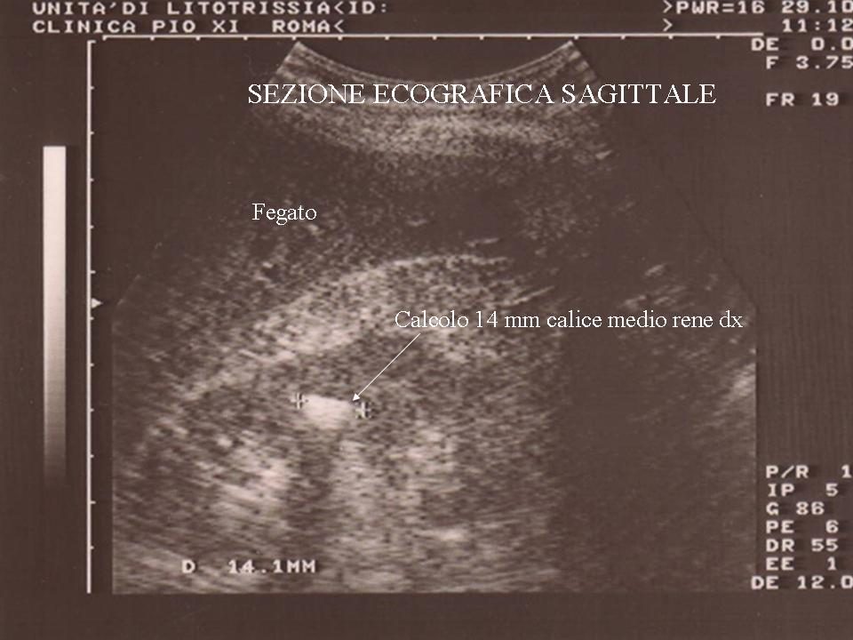 Unità di Litotrissia Extracorporea | Casi di litiasi Renale, Calcoli Renali