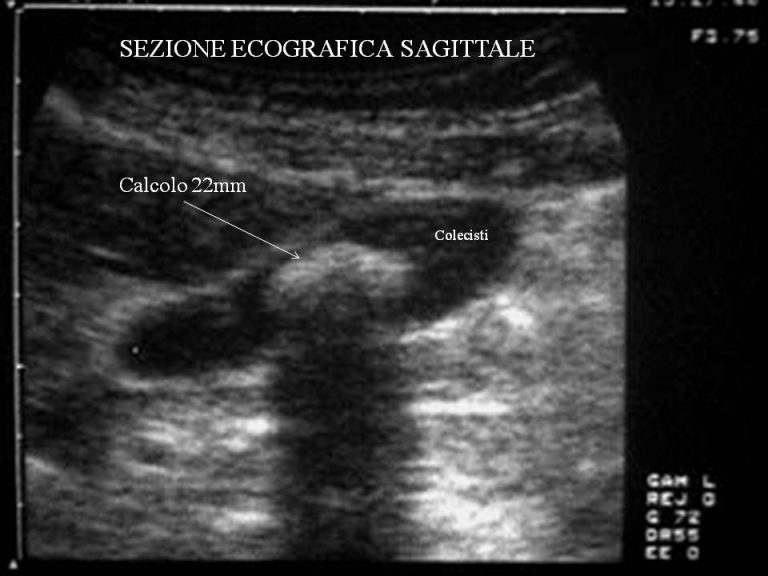 Calcolo Ø 22mm della colecisti - Unità Litotrissia Extracorporea Roma