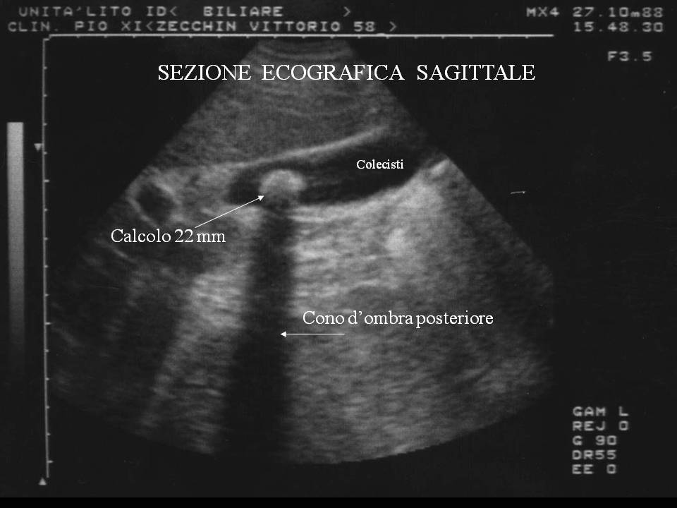 Calcolo Ø 22mm della colecisti - Unità Litotrissia Extracorporea Roma