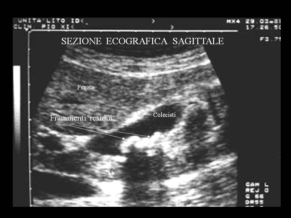 Calcolo Ø 4cm della colecisti - Unità Litotrissia Extracorporea Roma