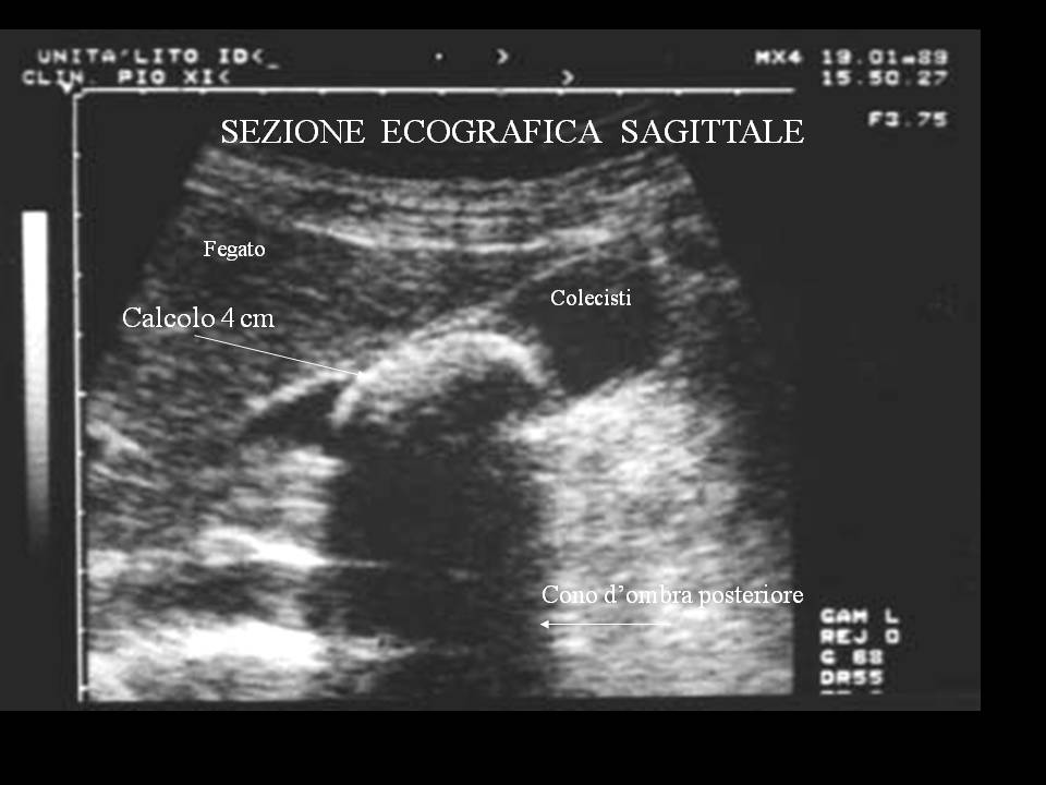 Calcolo Ø 4cm della colecisti - Unità Litotrissia Extracorporea Roma