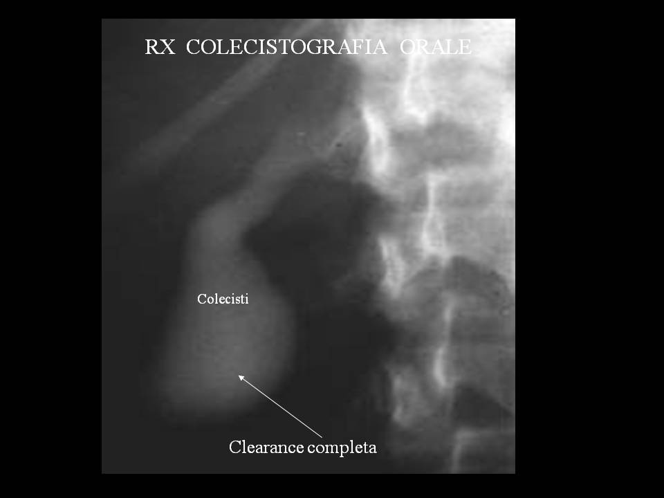 Calcolo Ø 4cm della colecisti - Unità Litotrissia Extracorporea Roma