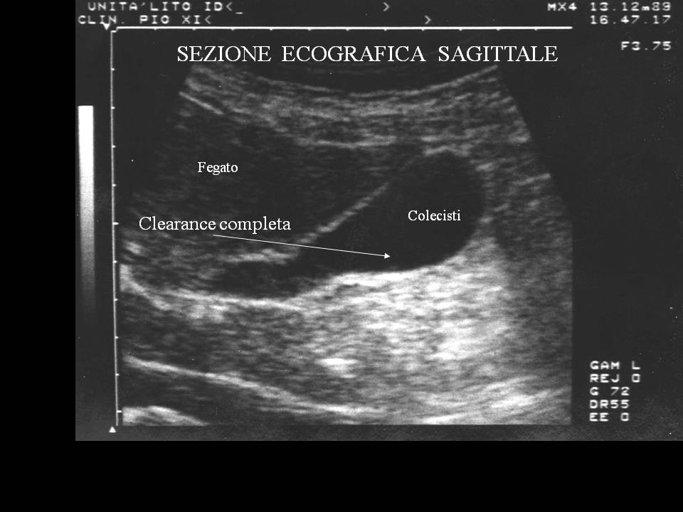 Calcolo Ø 4cm della colecisti - Unità Litotrissia Extracorporea Roma
