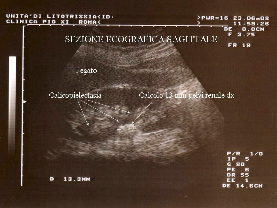 Unità di Litotrissia Extracorporea | Casi di litiasi Renale, Calcoli Renali