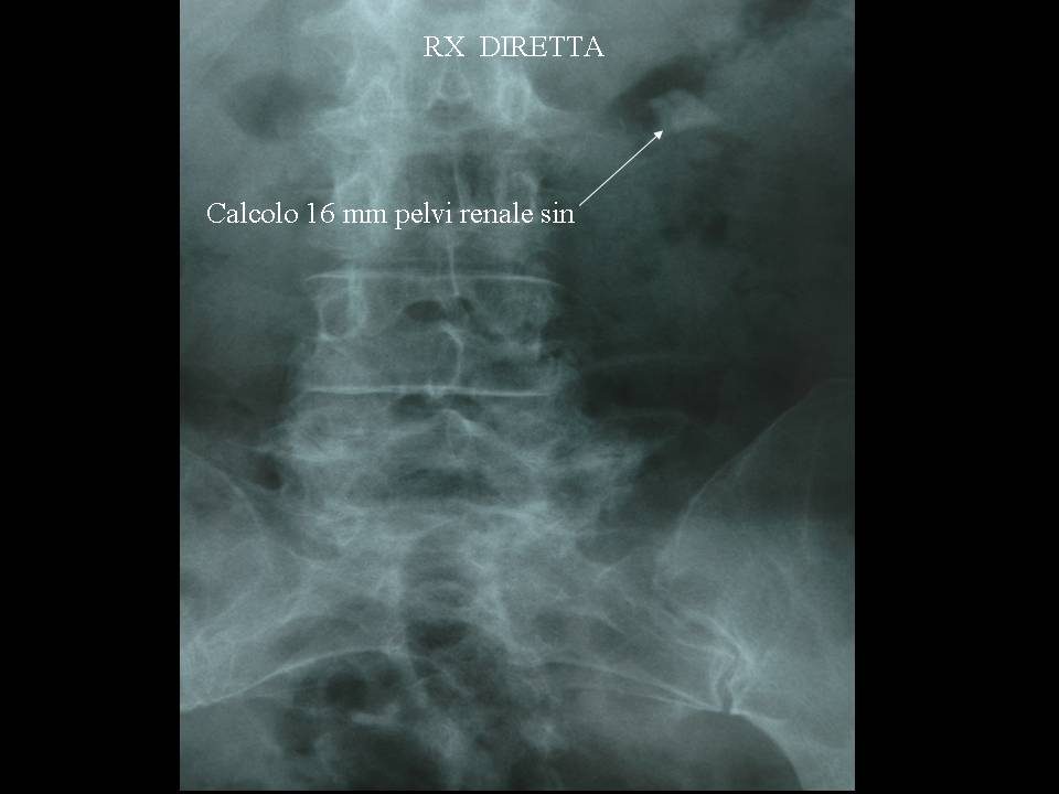 Unità di Litotrissia Extracorporea | Casi di litiasi Renale, Calcoli Renali