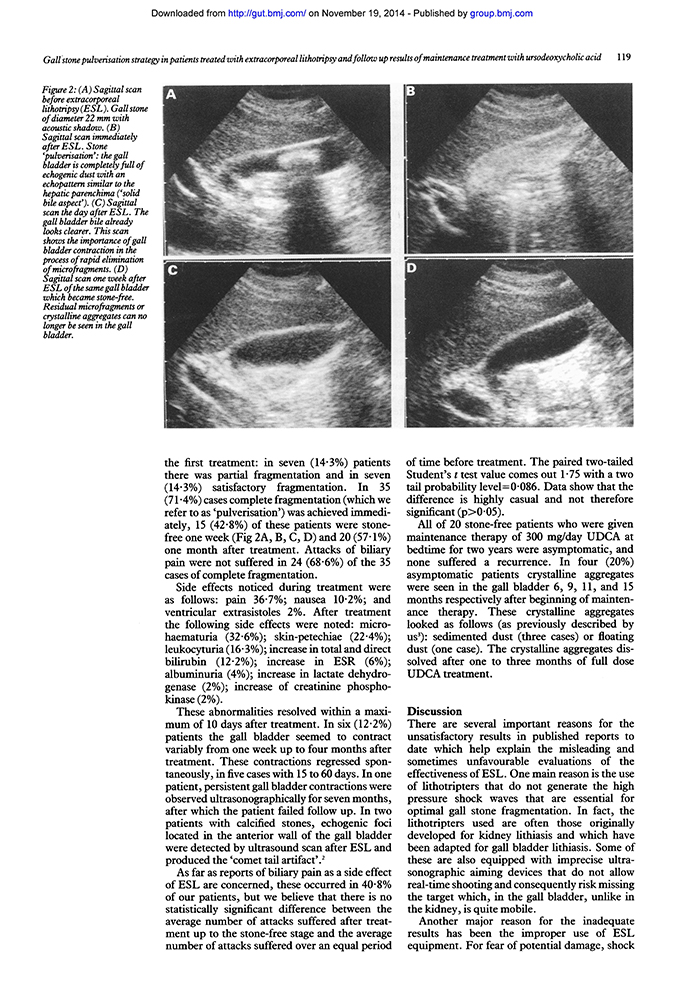 GALL STONE PULVERISATION STRATEGY - Litotrissia Extracorporea Roma