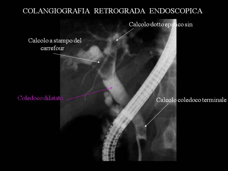 Litiasi multipla delle vie biliari con calcolo a stampo 25mm