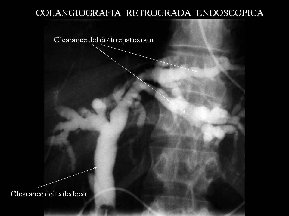 Litiasi multipla delle vie biliari intraepatiche - Unità Litotrissia Roma
